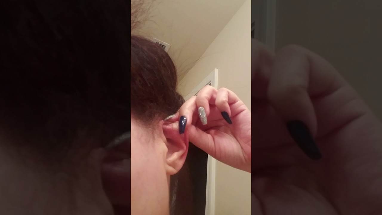 Removing Psoriasis from my ear with my nails - YouTube