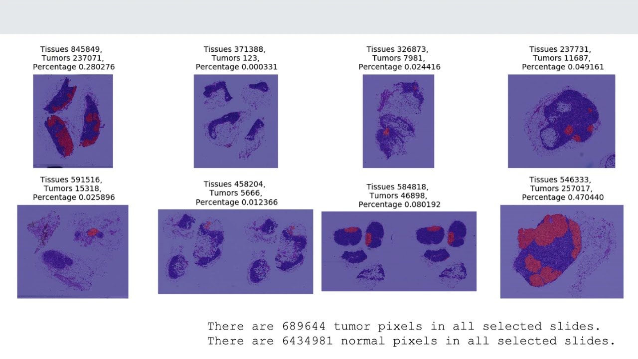 Masking Cancer Metastases on Gigapixel Pathology Images by Ruizhi Zhang - YouTube