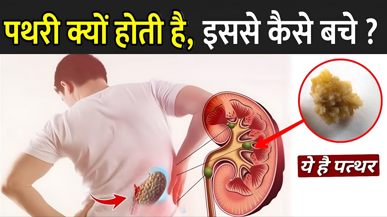 पथरी क्यों होती है, इससे कैसे बचे ? | Pathri Kyu Hota Hai | Pathri Ka ilaj - YouTube