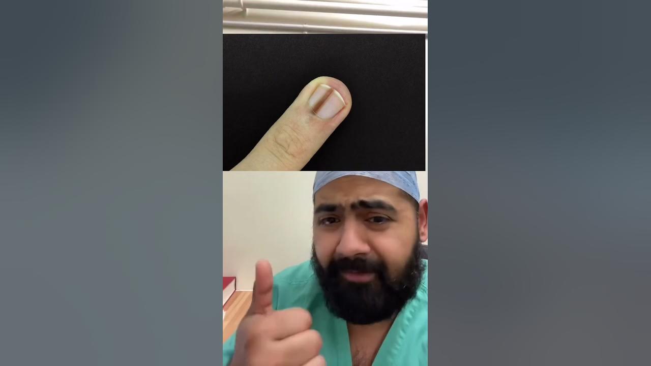 What To Do If You Have A Dark Line On Your Nail YouTube what-to-do-if-you-have-a-dark-line-on-your-nail-youtube