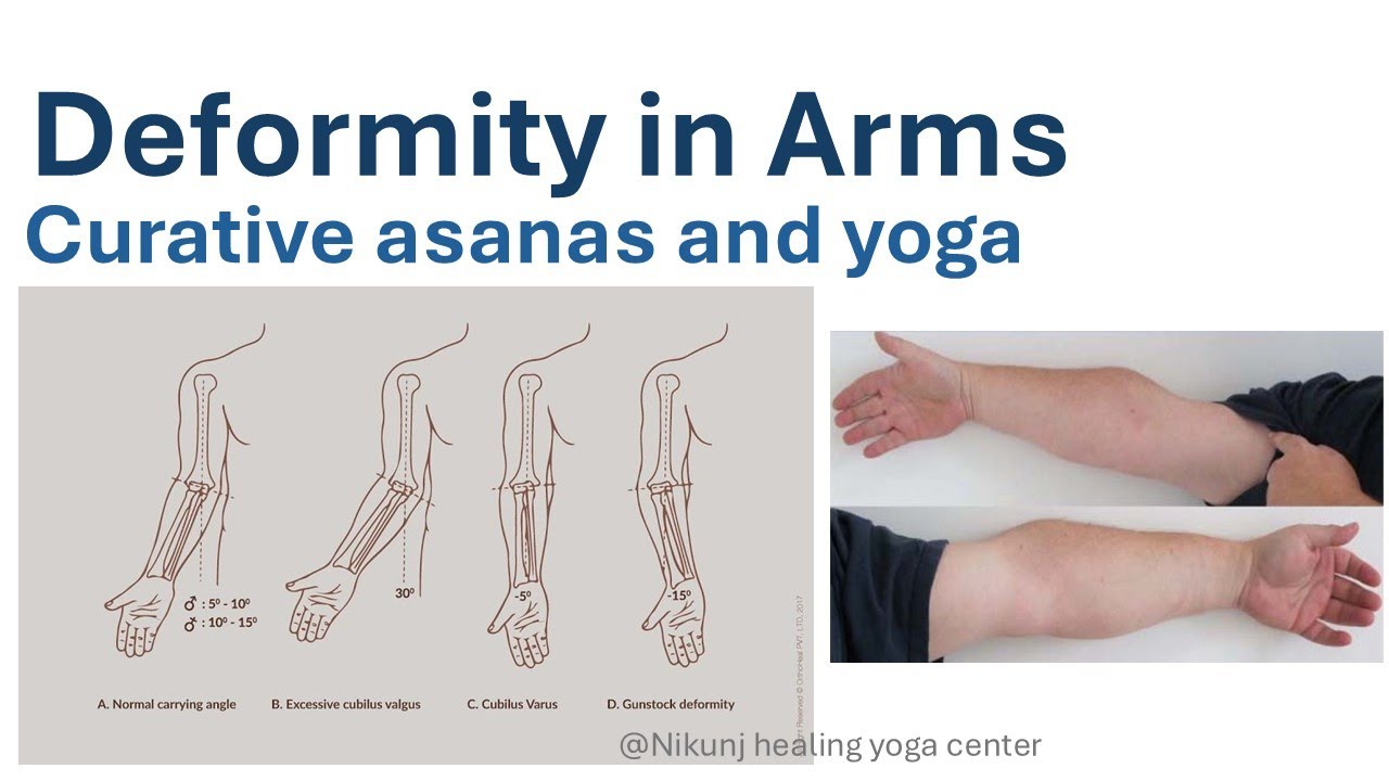 Deformity in arms @Nikunj healing yoga center - YouTube