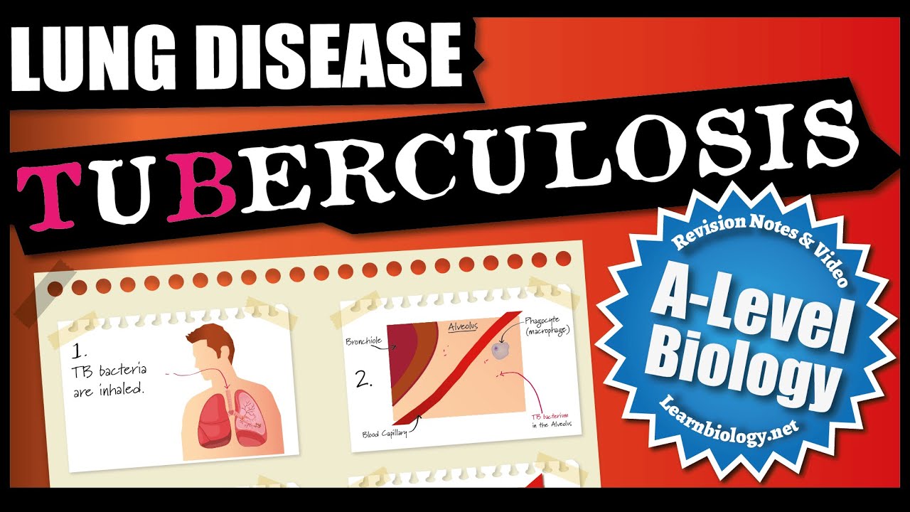 Lung Diseases | TB - Tuberculosis | A Level Biology Revision Notes ...