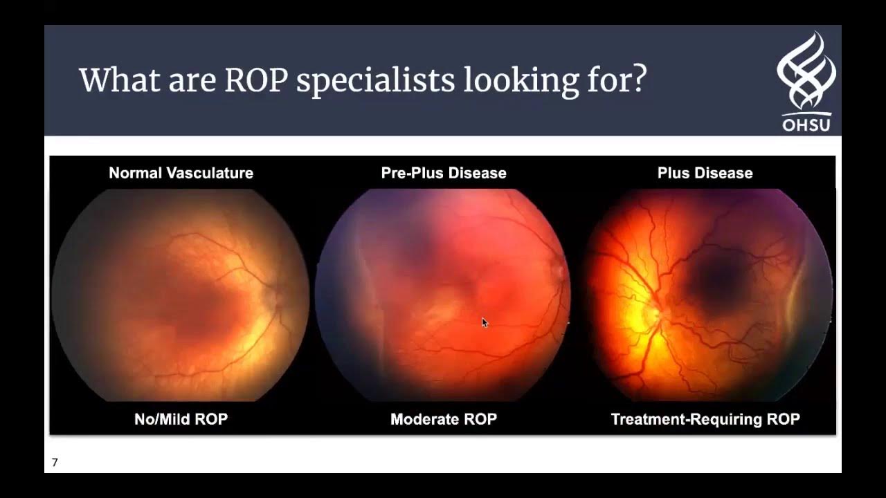 Machine Learning For Disease Detection And Prediction In Retinopathy Of Prematurity Youtube