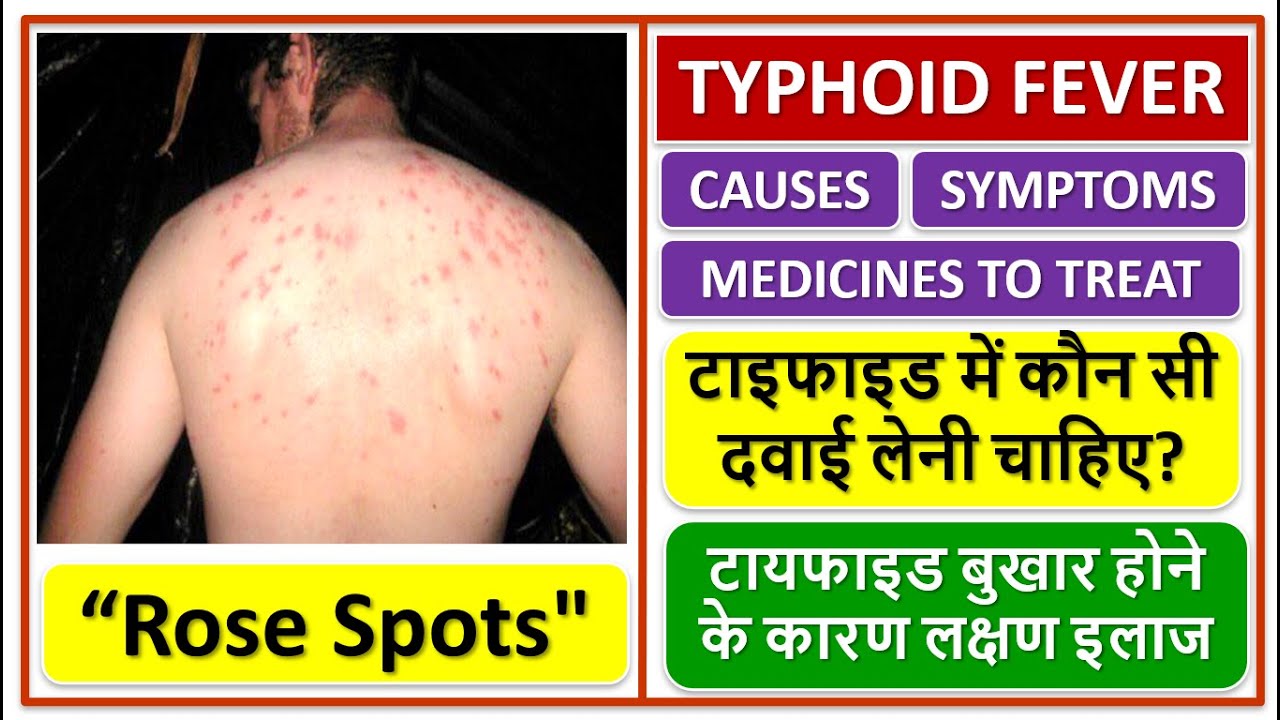 Typhoid Fever Rose Spots