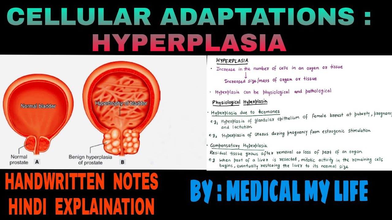 Cellular Adaptations - 1 | Hyperplasia | Pathology - YouTube