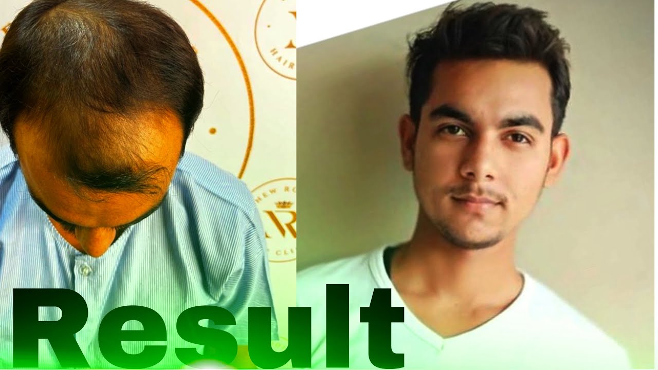 Hair transplant result after 70 days || hair transplant || - YouTube