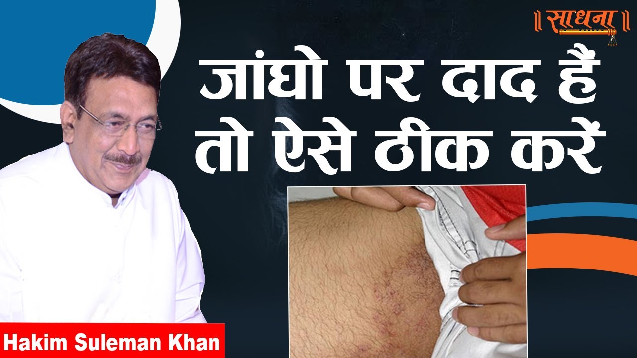 जांघो पर दाद हैं तो ऐसे ठीक करें। Hakim Suleman Khan - YouTube