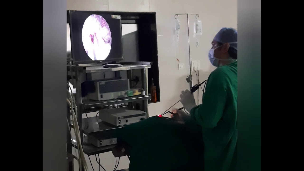 Endoscopic septoplasty for deviated nasal septum(surgical video)(1/3 ...