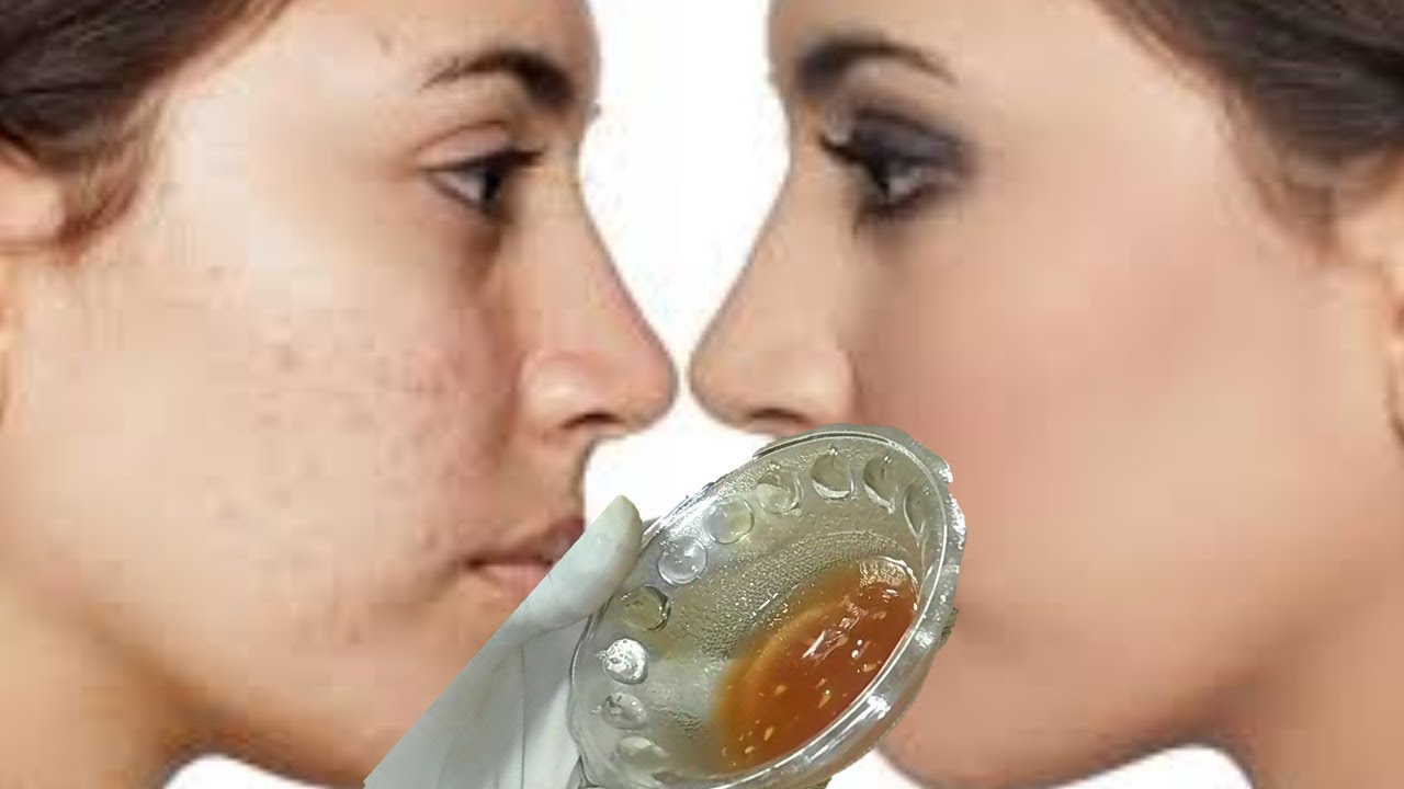 Black spots And Acne spot Remove Just One Simple Pack | How To Clean ...