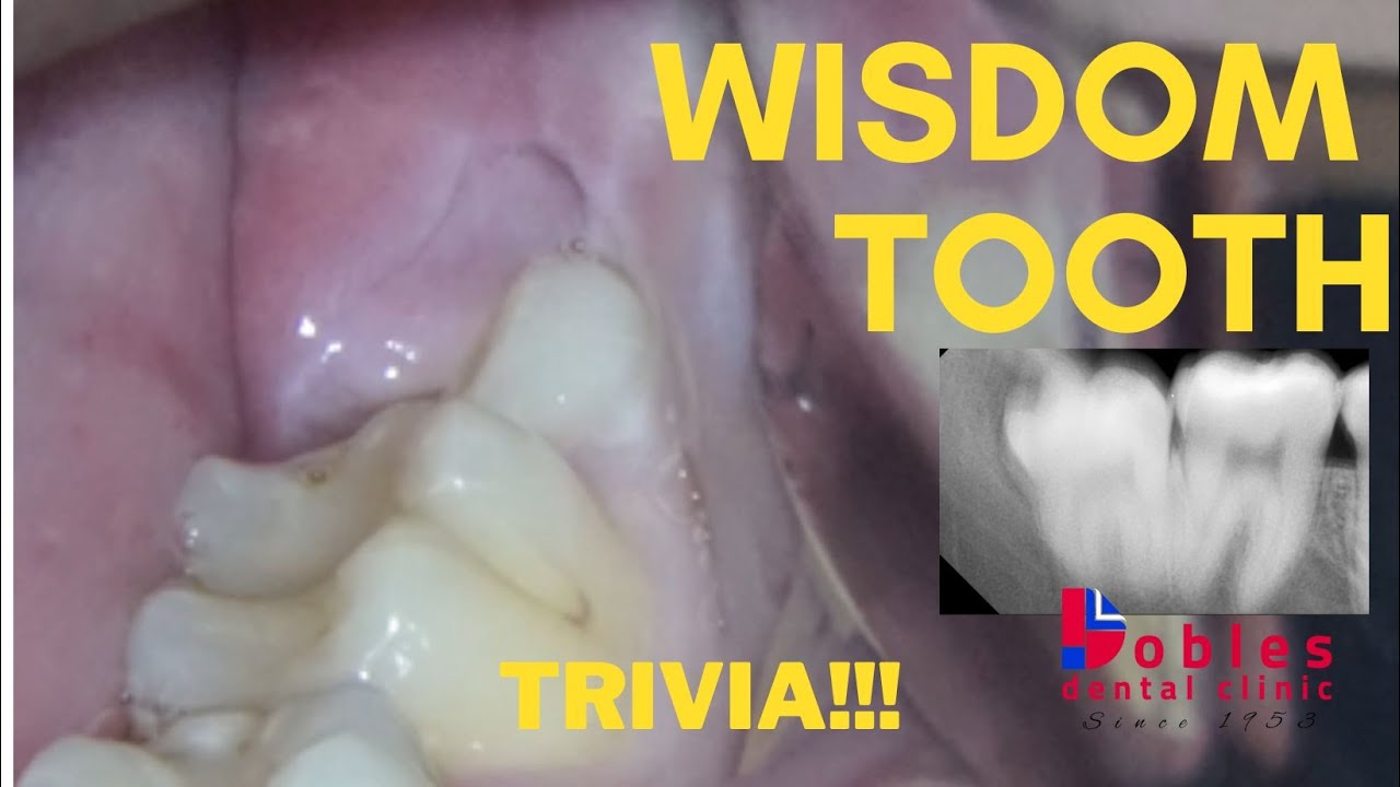 WISDOM TOOTH TRIVIA FOR YOU TO KNOW - YouTube