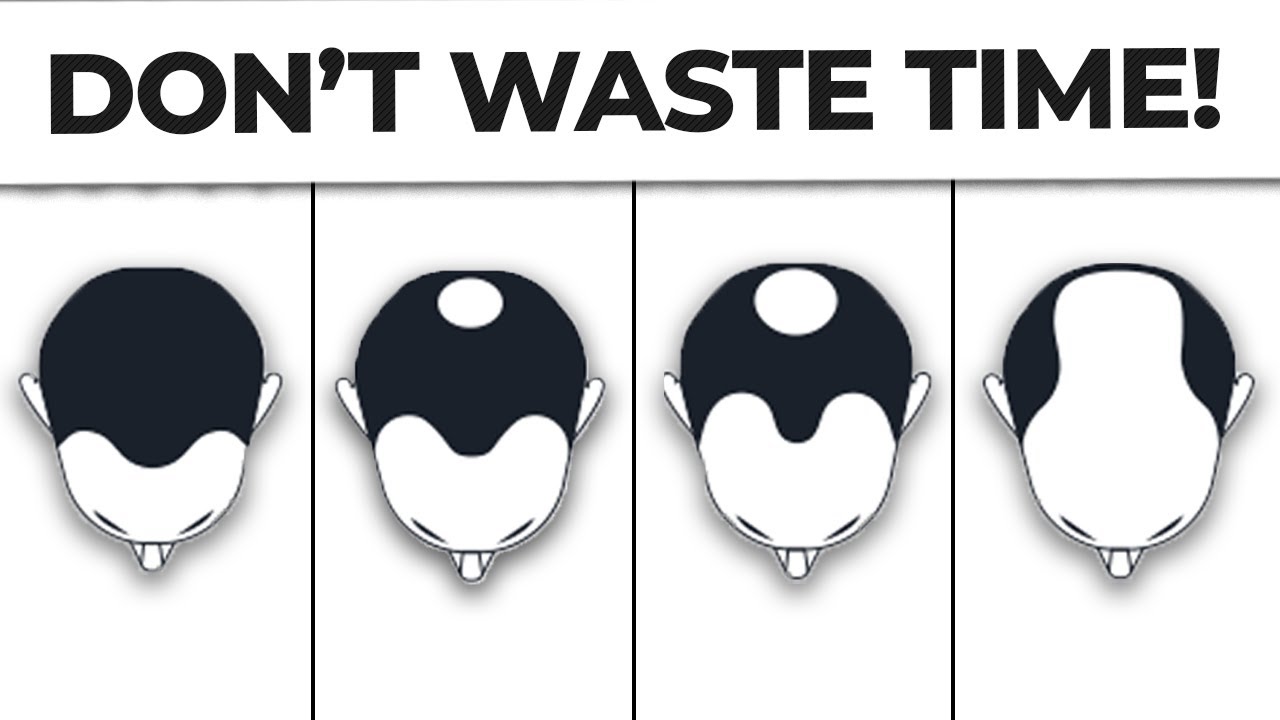 Balding Speeds Vary, So Don't Make This Mistake - YouTube