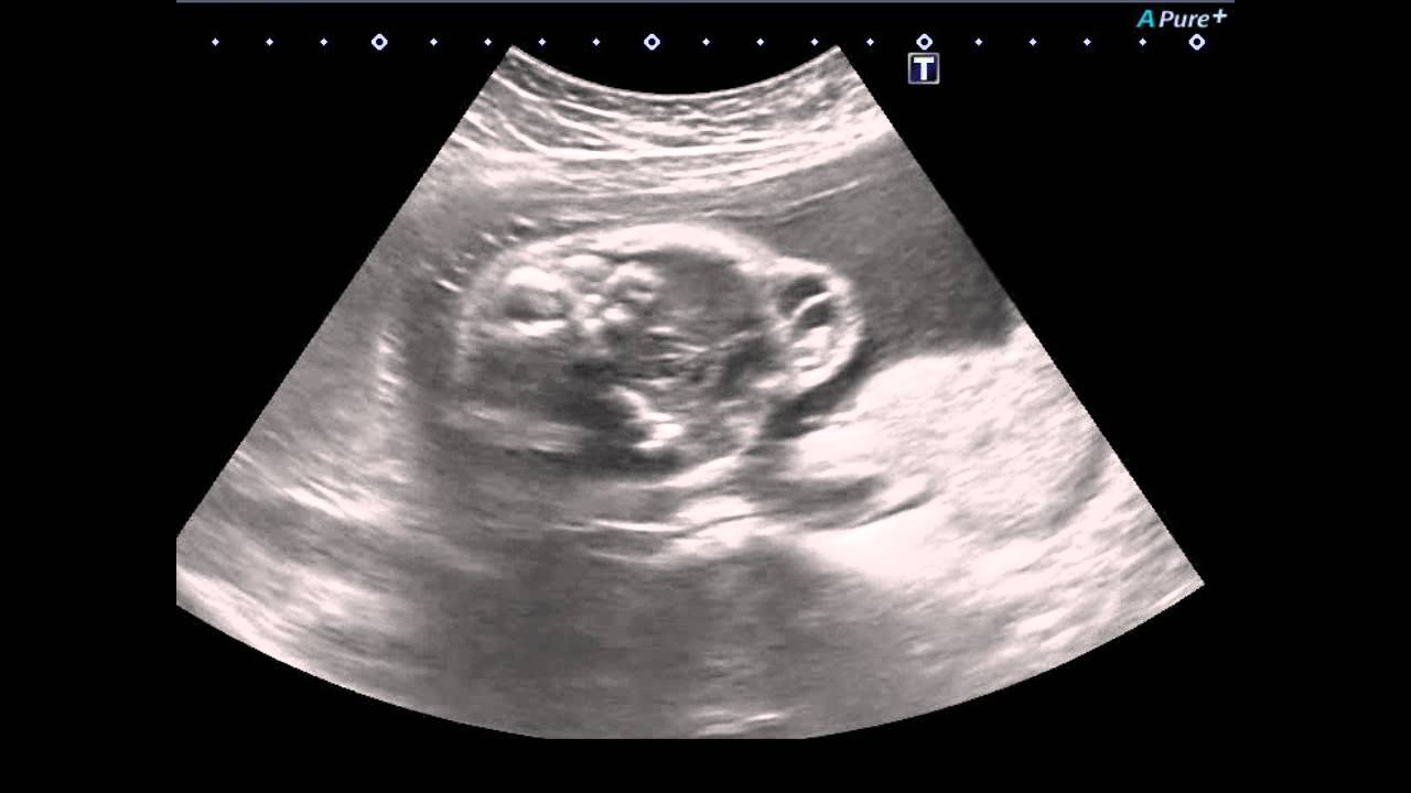 Encefalocele - YouTube