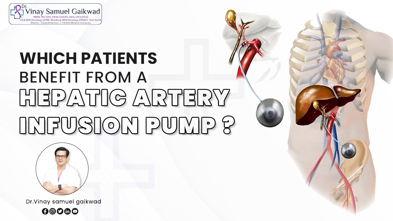 Which patients Benefit from a Hepatic Artery Infusion (HAI) Pump? | Dr. Vinay Samuel Gaikwad # ...