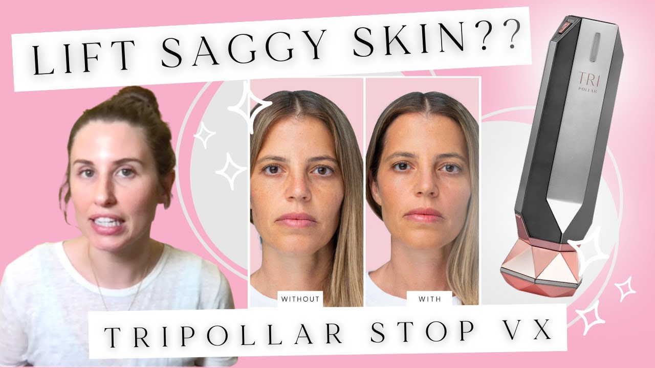 Skin Tightening At Home: Tripollar STOP VX REVIEW | Does At Home Radio ...