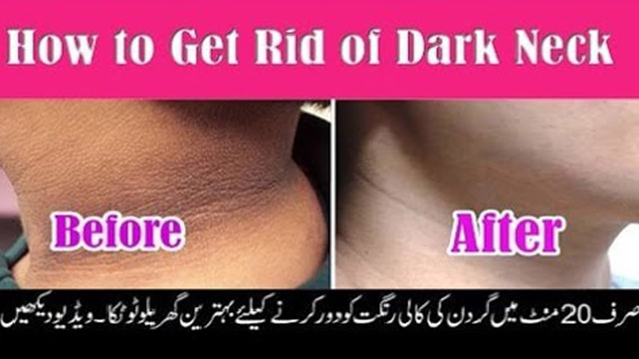 3 Steps How To Get Rid Of Dark Neck/ Naturally Fair Neck/ 100% ...