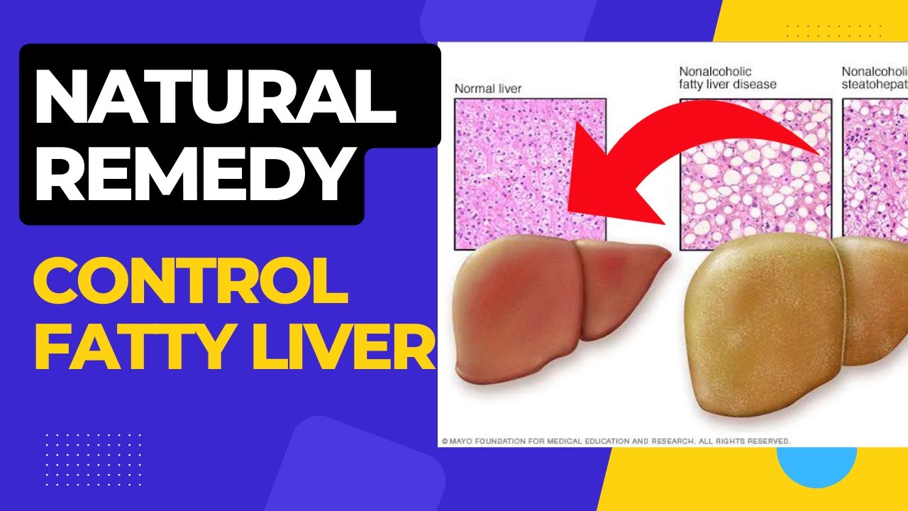 How do you reduce liver fat accumulation? - YouTube
