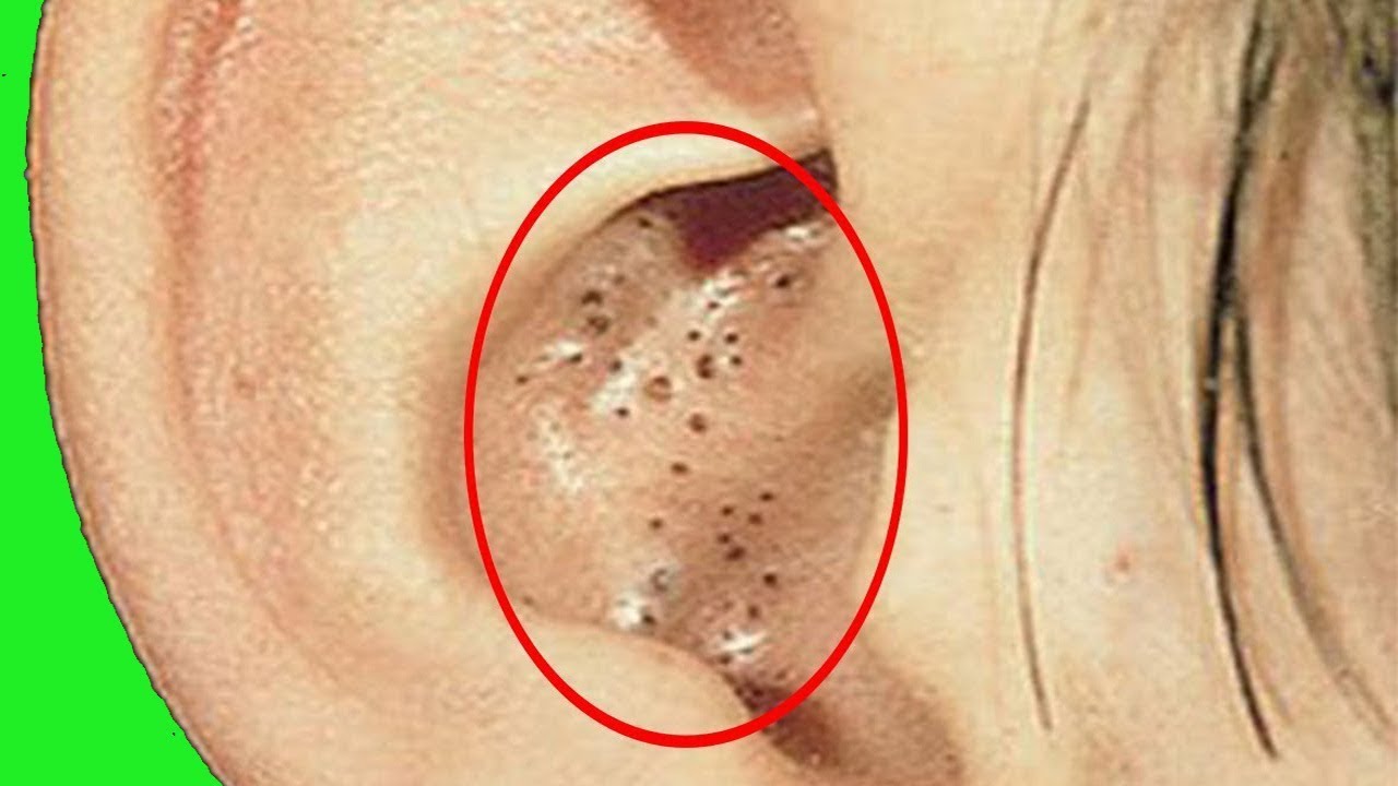 How Do You Get Rid Of Blackheads In Your Ears YouTube how-do-you-get-rid-of-blackheads-in-your-ears-youtube