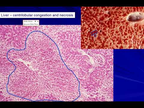 Liver: Chronic venous congestion - YouTube