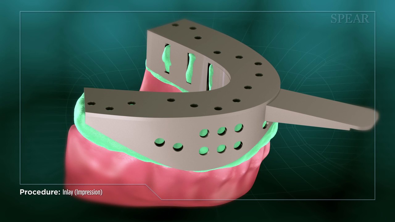 Inlay (Impression).flv - YouTube