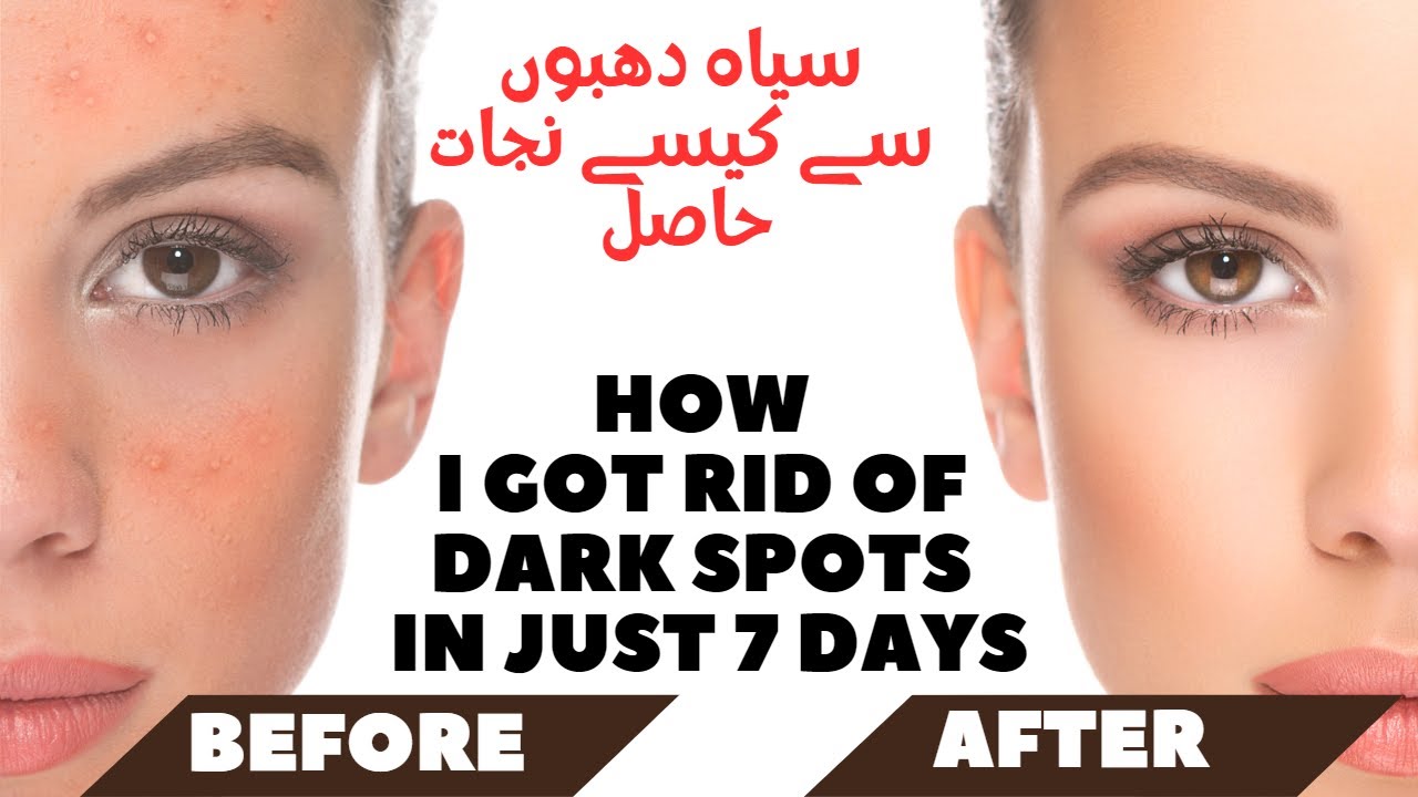 How I Got Rid of Dark Spots in Just 7 Days with This DIY Pigmentation ...