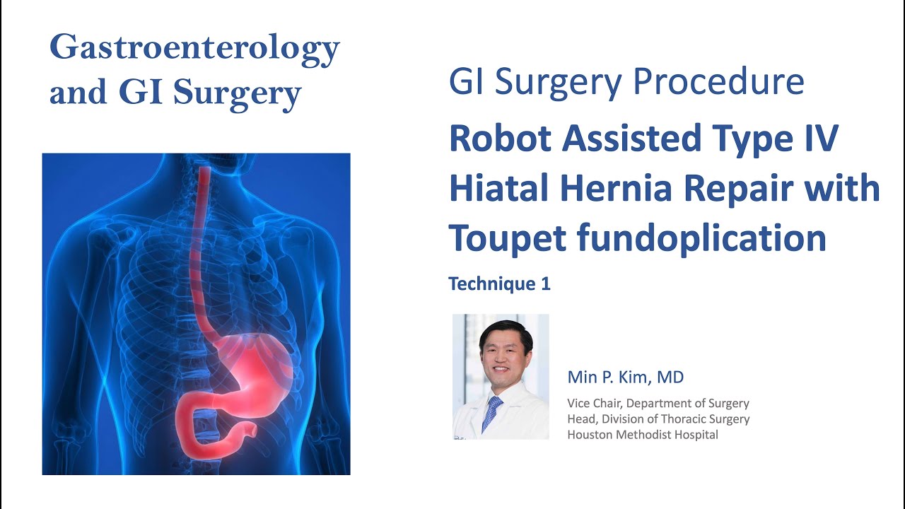 Robot Assisted Type IV hiatal hernia repair with Toupet fundoplication ...