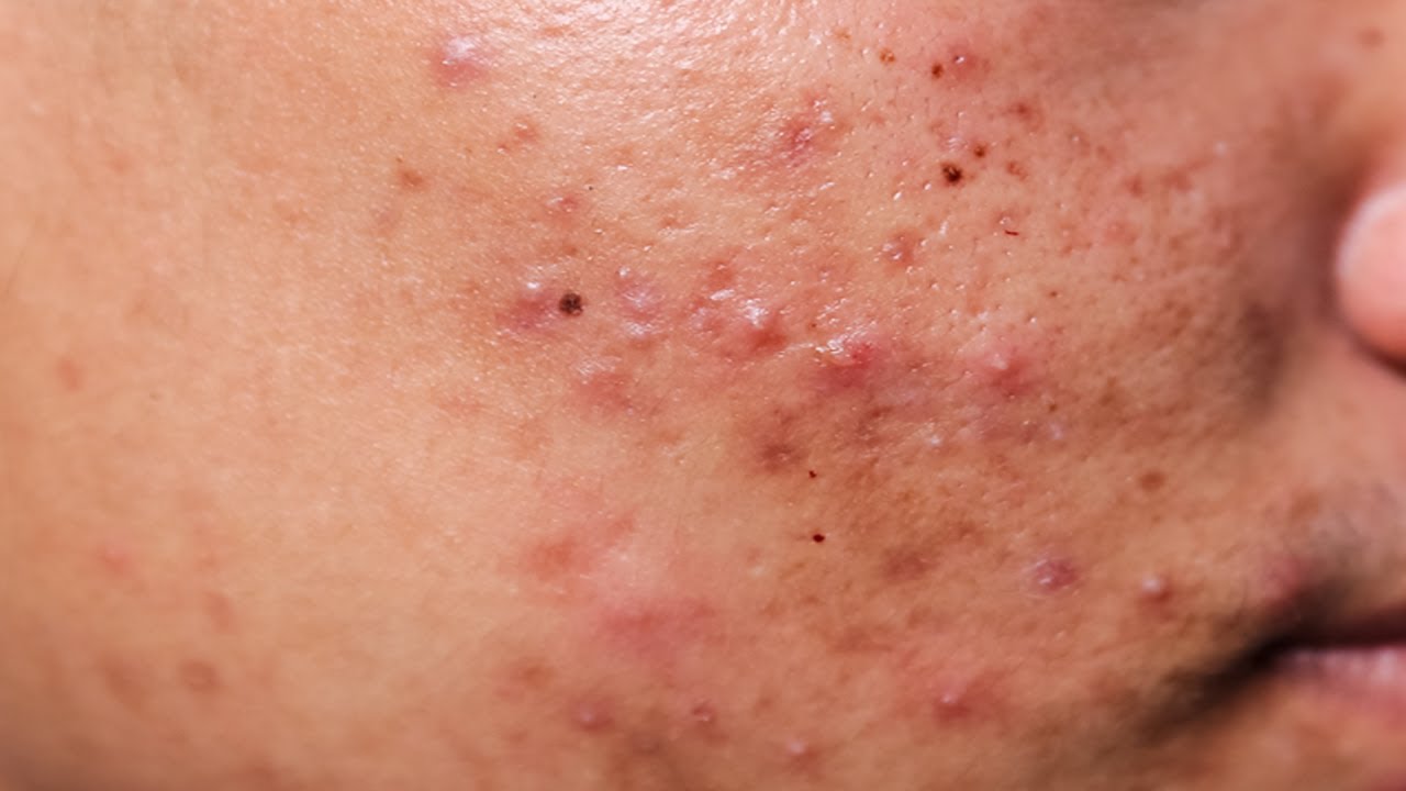 NEW Pimple Popping Compilation | Blackheads remover | Acne removal ...