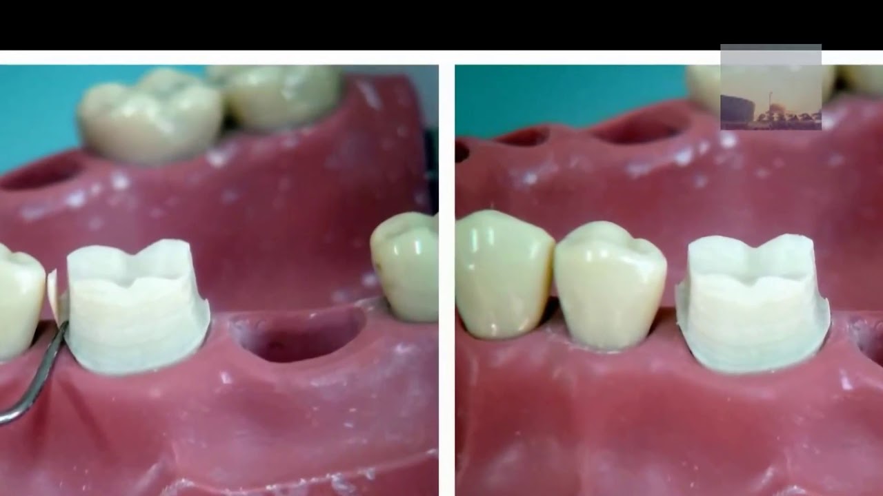 Full Metal Crown Preparation | For Dental Students - YouTube