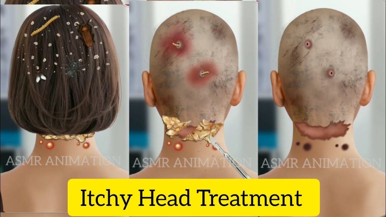 ASMR Itchy Head Treatment | @Asmranimation30 - YouTube