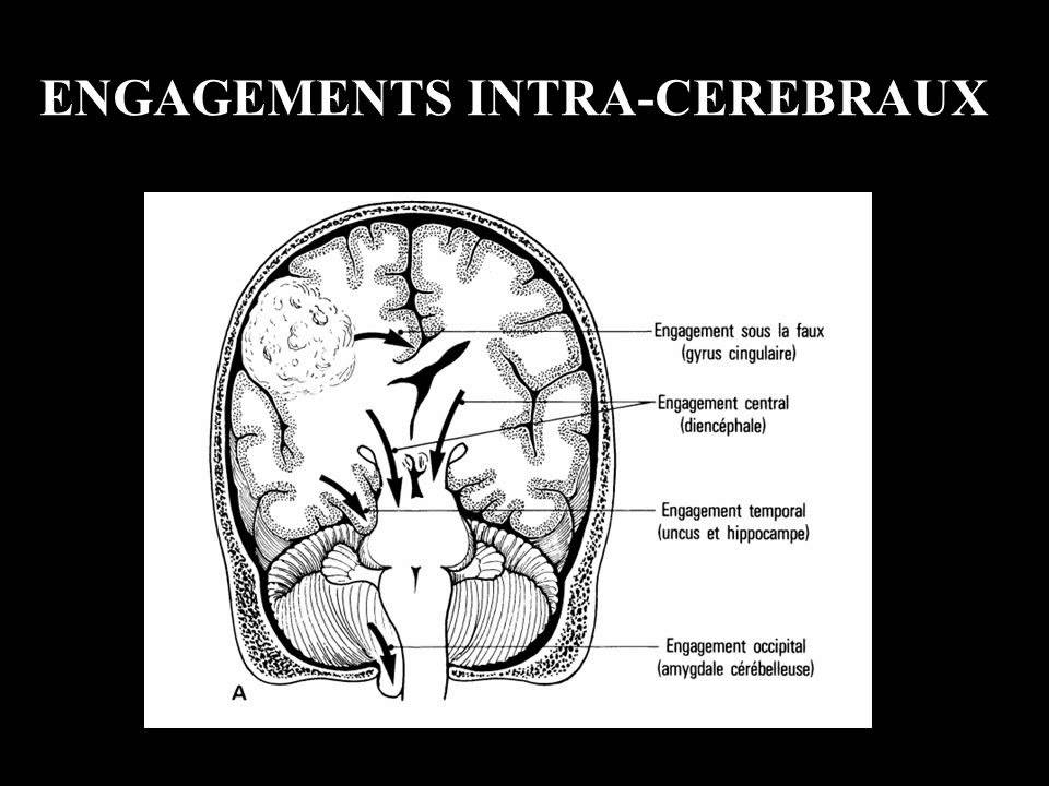 NEUROLOGIE Hypertension intracrânienne 2016 - YouTube