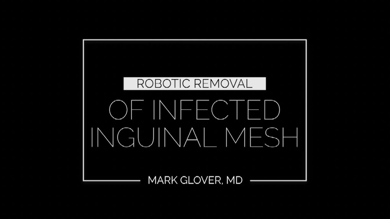 Robotic Infected Inguinal Mesh removal - YouTube