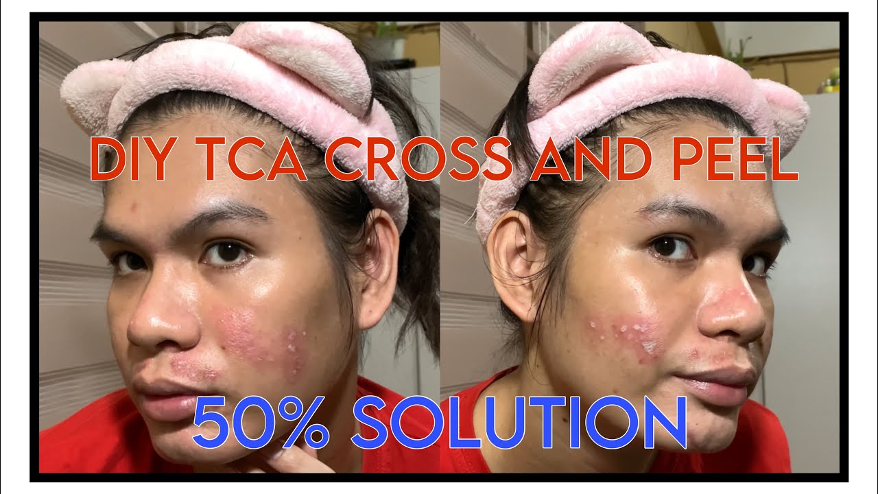 Part 1: DIY TCA CROSS AND PEEL using 50% Solution | Acne Scars/Pimple ...