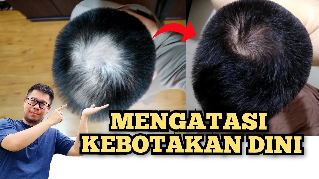 MENGATASI KEBOTAKAN DINI - YouTube
