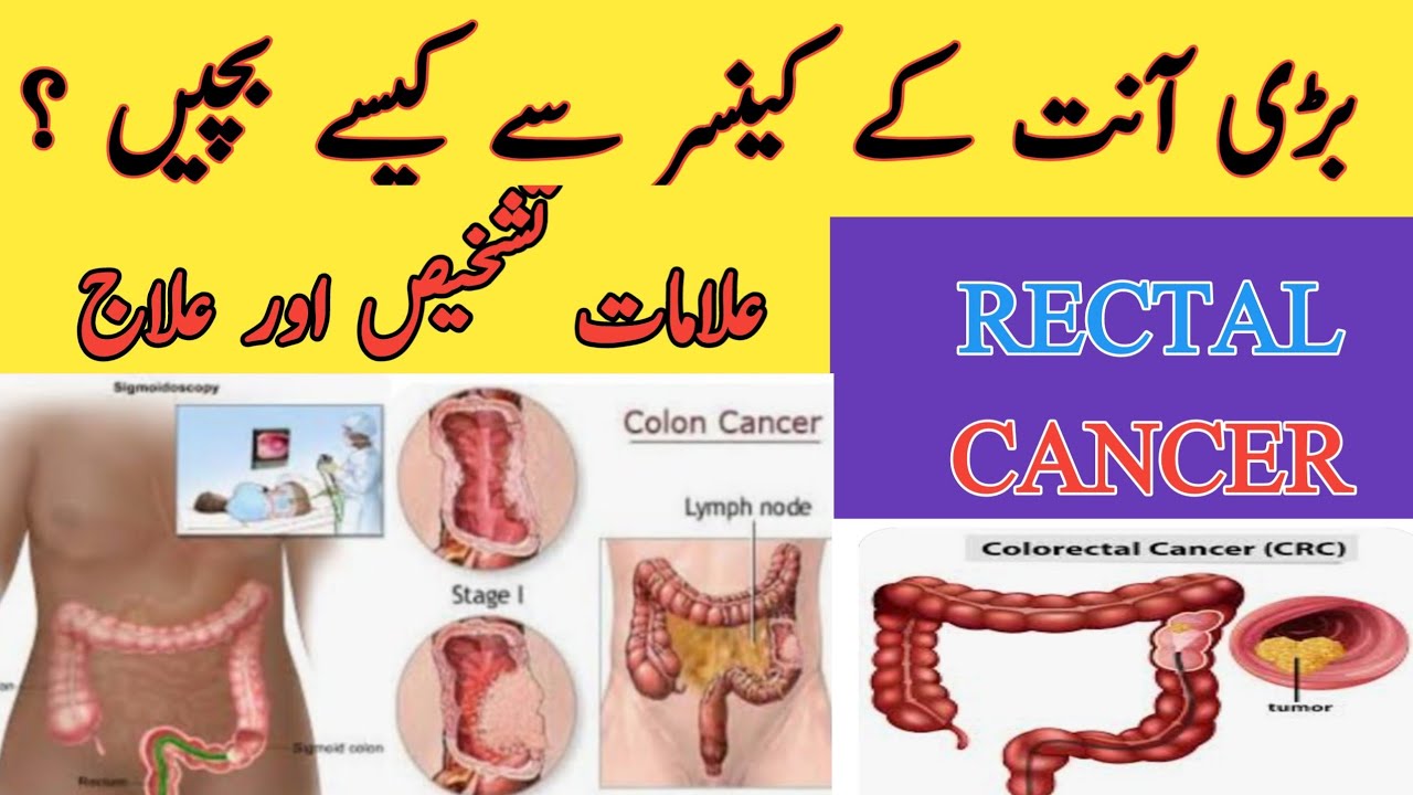 Colorectal Cancer Symptoms & Treatment/Bari aant ka Cancer Kya Hai Urdu ...