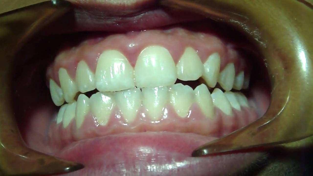 EVALUACIÓN DINÁMICA DE LA OCLUSIÓN (PROTRUSIVA CON GUÍA ANTERIOR) - YouTube