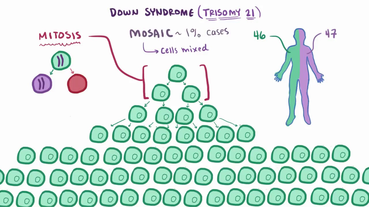Down syndrome trisomy 21 causes, symptoms, diagnosis, & pathology - YouTube