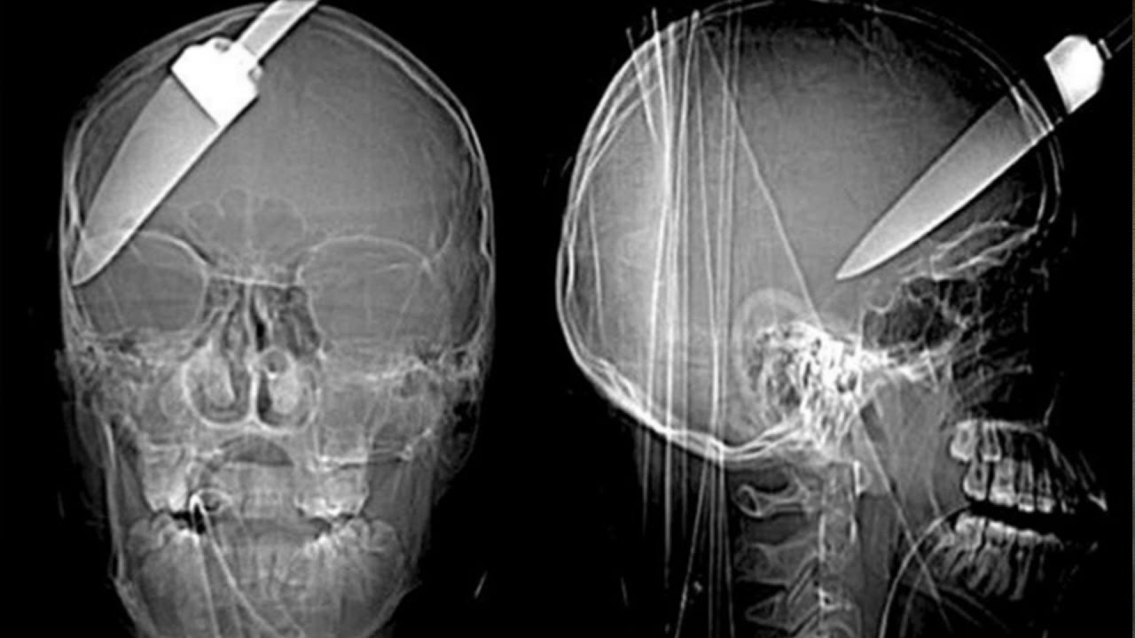 Top 15 Strangest Things Found in an X-Ray - YouTube