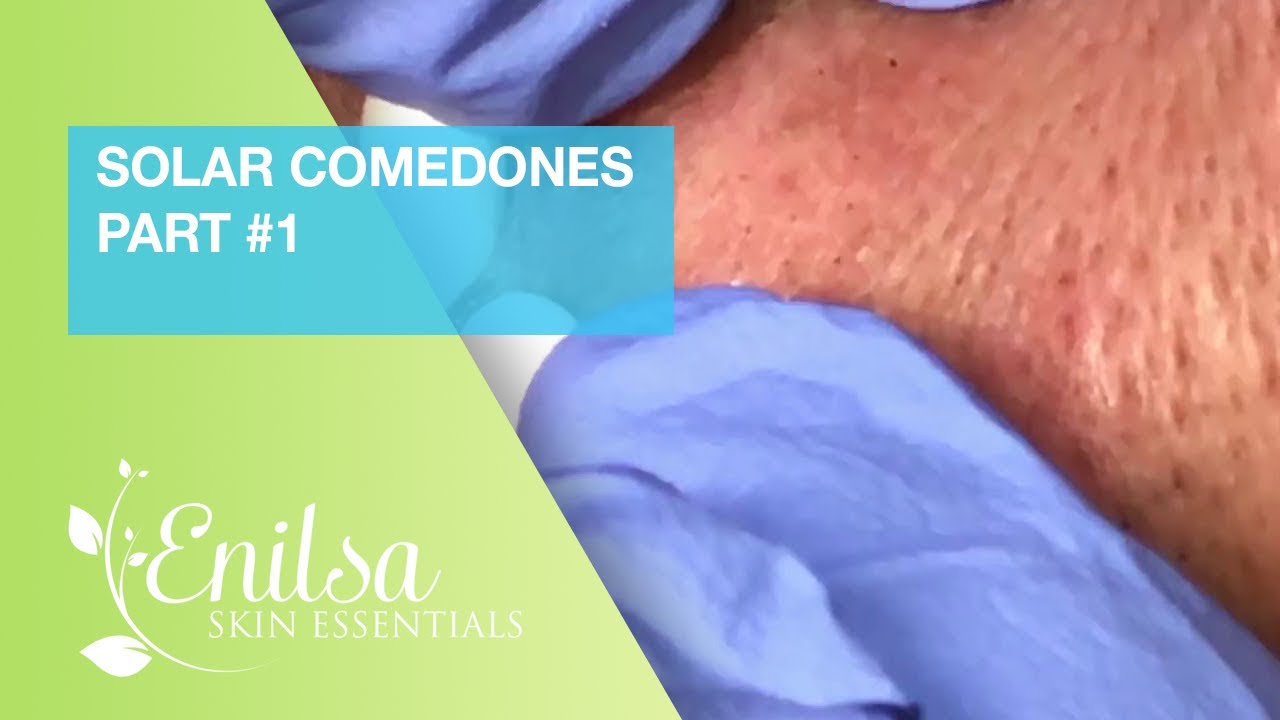 Solar Comedones - YouTube