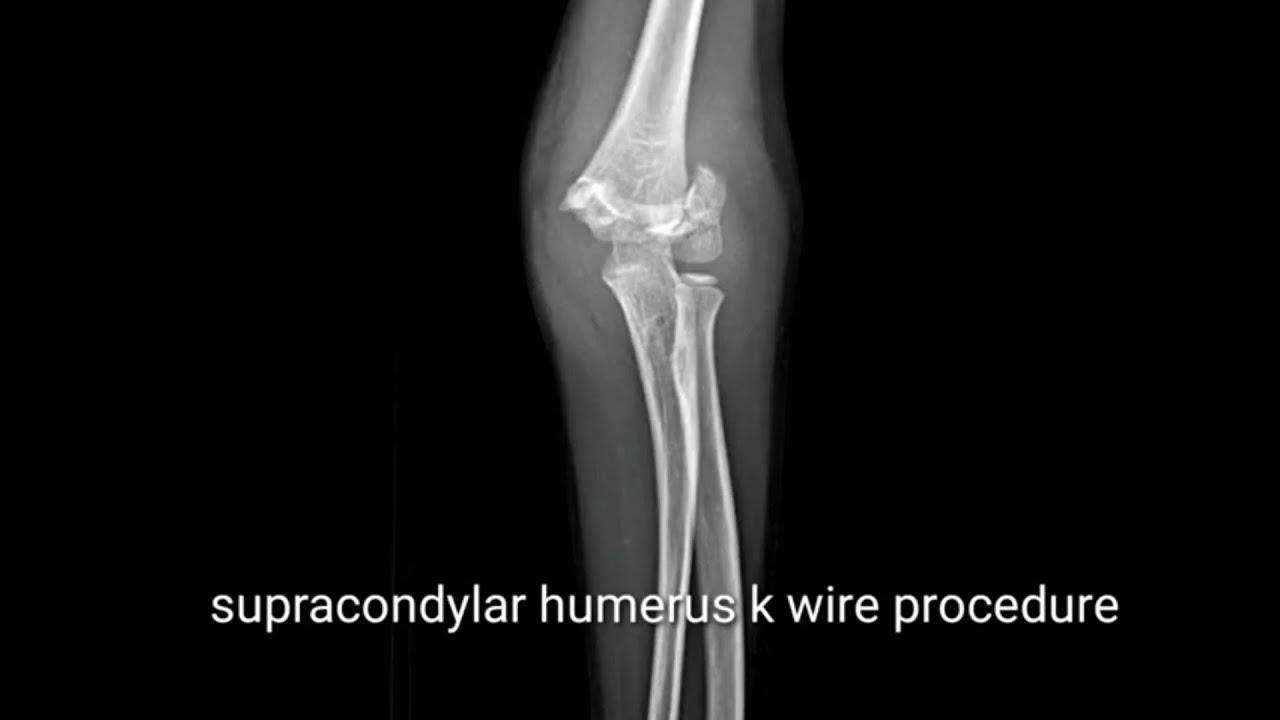 supracondylar humerus percutaneous k wire surgical technique - YouTube