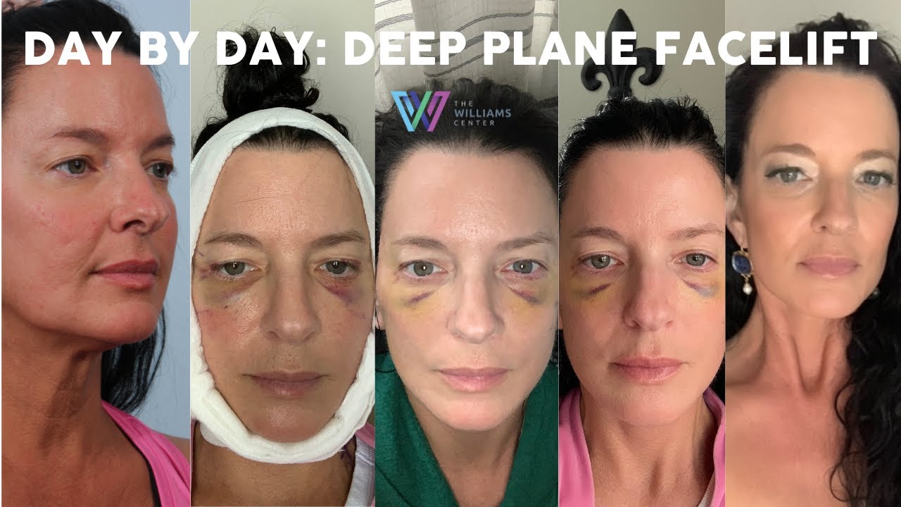 Day by Day Deep Plane Facelift Recovery: Three Months Post-Op - YouTube
