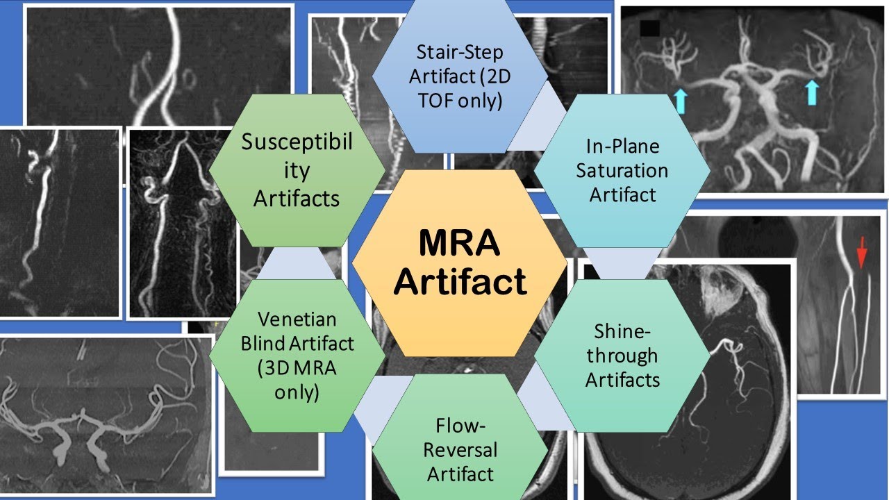 The TOF MRA Artifact - What is it? - YouTube