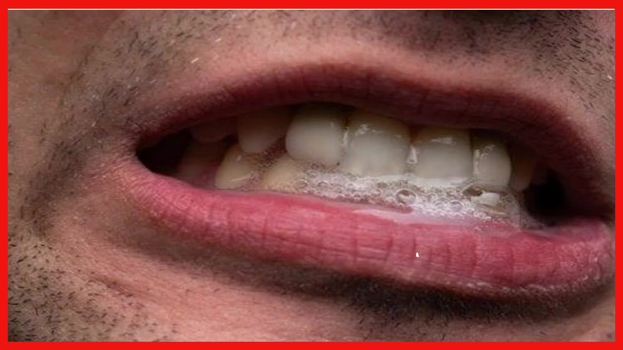 Sialorrea: ¿qué es y cuál es su tratamiento? - YouTube