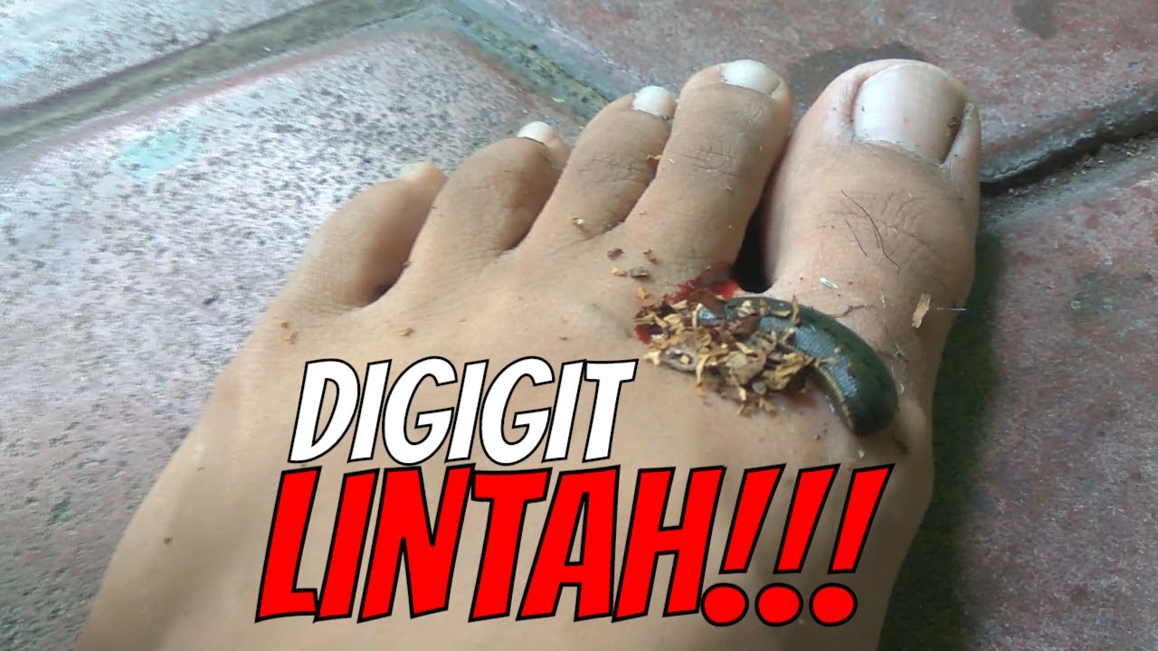 Digigit Lintah - Cara lepaskan gigitan lintah | Orang digigit Lintah ...