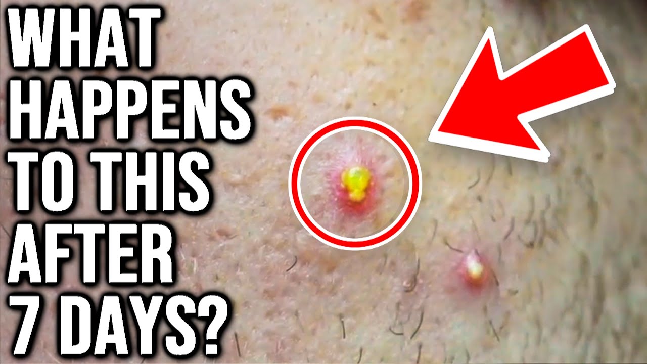 What Happens If You DON'T Touch Your Acne? - YouTube