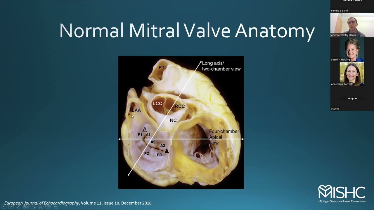 Dr Andrew Harris Presents Mitral Valve Echocardiographic Assessment Dr Andrew Harris Presents Mitral Valve Echocardiographic Assessment