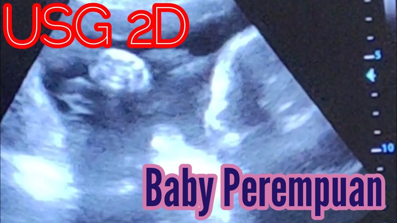 USG 2D Bayi perempuan sehat - YouTube
