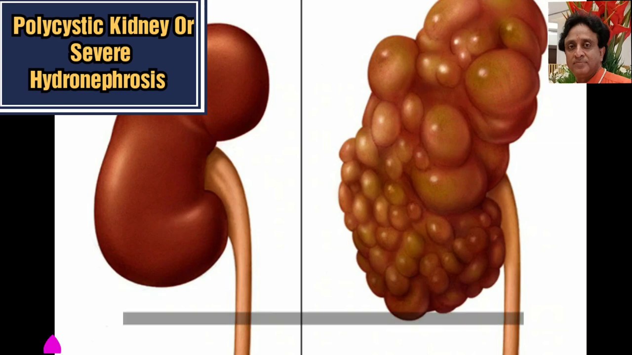 Polycystic Kidney how to Differentiate from Severe Hydronephrosis, tips ...