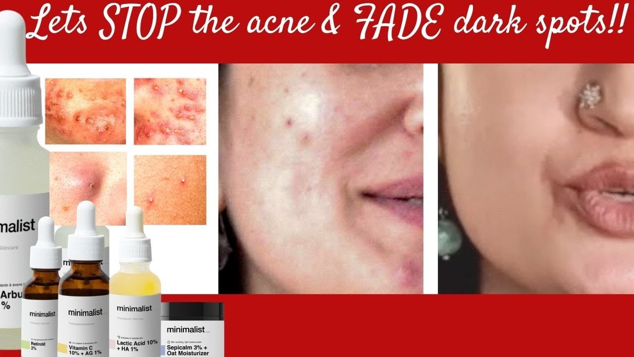 Be Minimalist Layering For Pimple /Acne Free Clear Skin | Big and Small ...