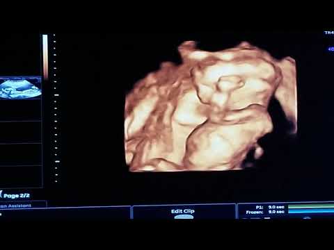 Tickling Autumn's feet 17 wk U/S