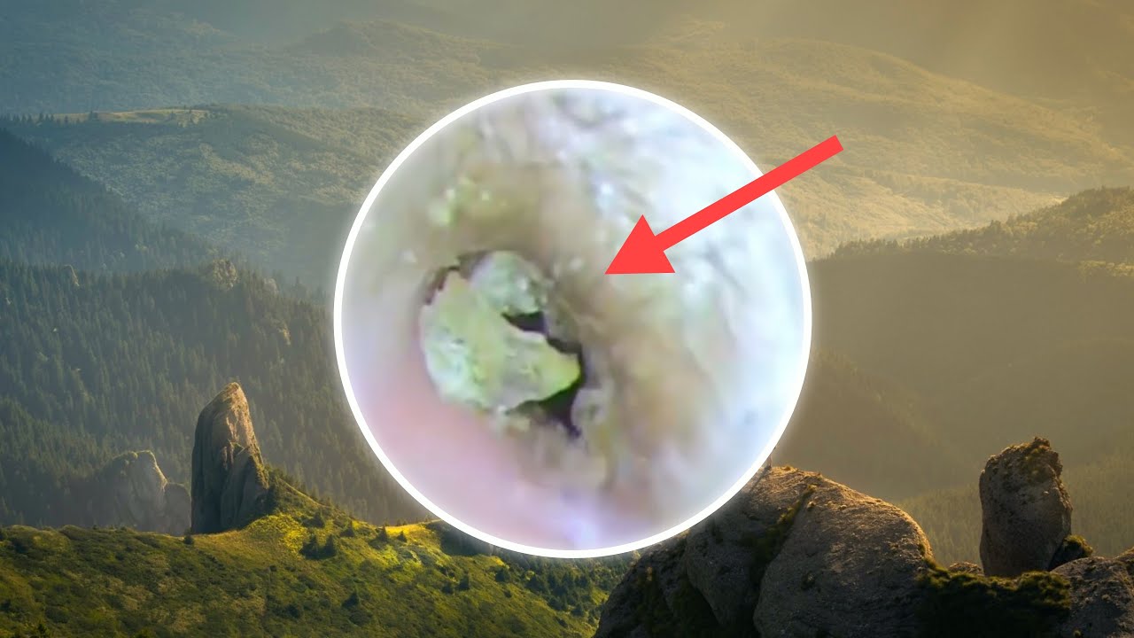 Very Small Ear Canal , Please Care Your Ear it Very Hard to Clean - YouTube