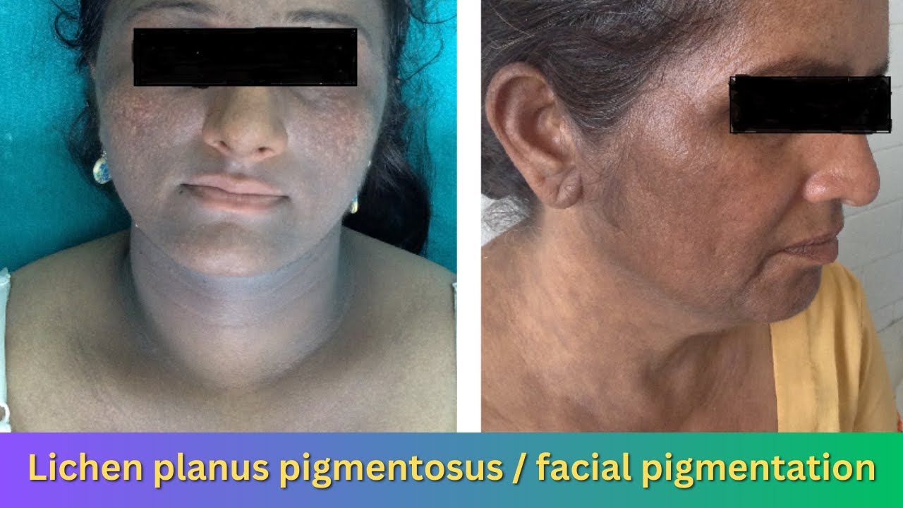 Lichen planus pigmentosus / facial pigmentation #lp / Achanak chehra ...